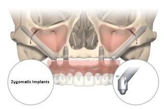 An Alternative for Severe Bone Loss of the Upper Jaw
